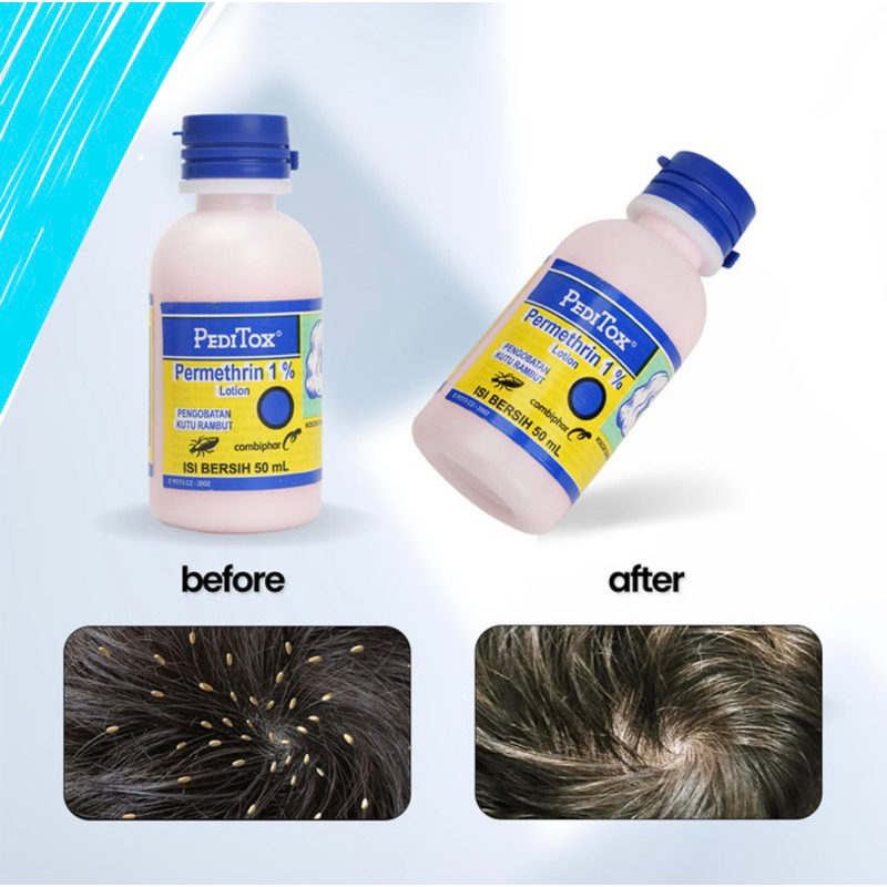 rawatan kutu rambut peditox 50ml original | Shopee Malaysia