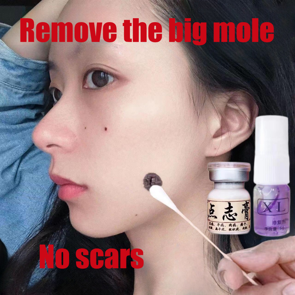 Mole remover Cream ubat kutil tahi lalat ketuat dan biji kolesterol ...