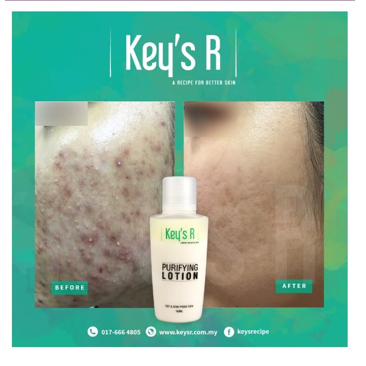Key's R Purifying Lotion pimples solution keysr 祛痘专家 洁净护肤水 马来西亚卫生部 KKM ...