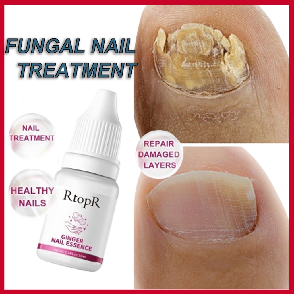 Ubat Kuku Rosak RtopR Nail Serum Toe Nail Care Cekam Rosak Fungal Nail ...
