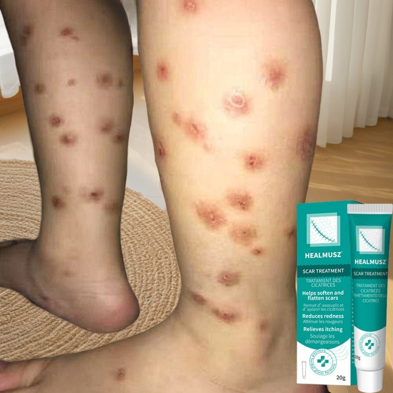 Scar Cream hilangkan parut scar removal Stretch Marks Burns Scald Ubat ...