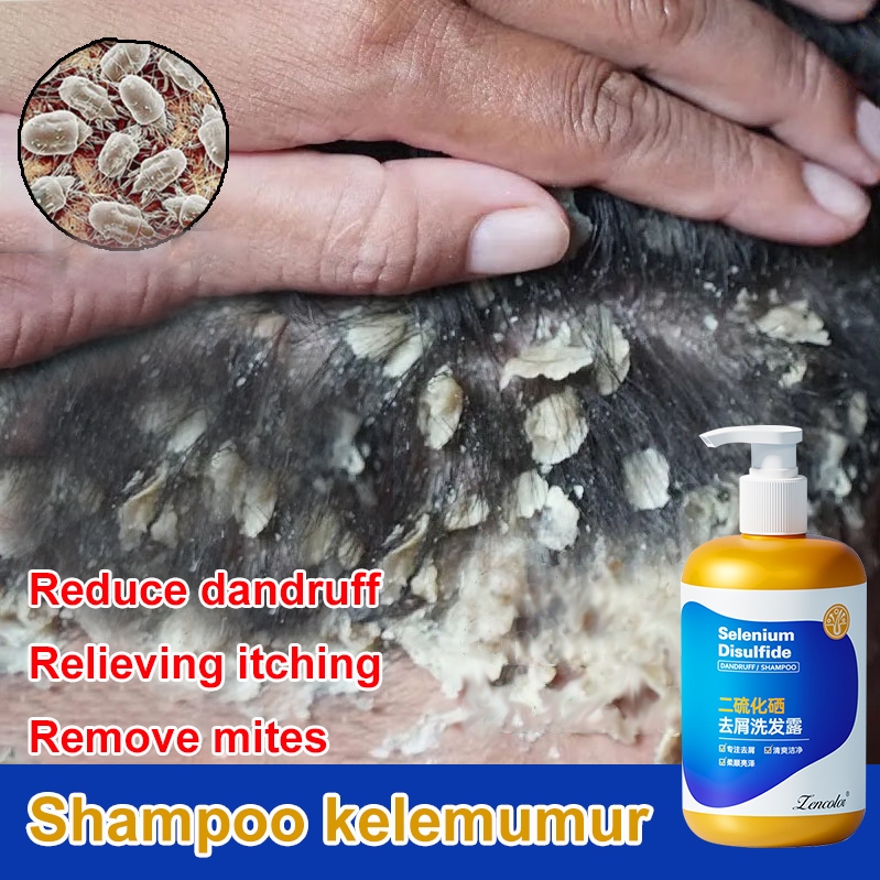 shampoo kelemumur scalp shampoo dandruff shampoo止痒去屑洗发水300ml removes ...