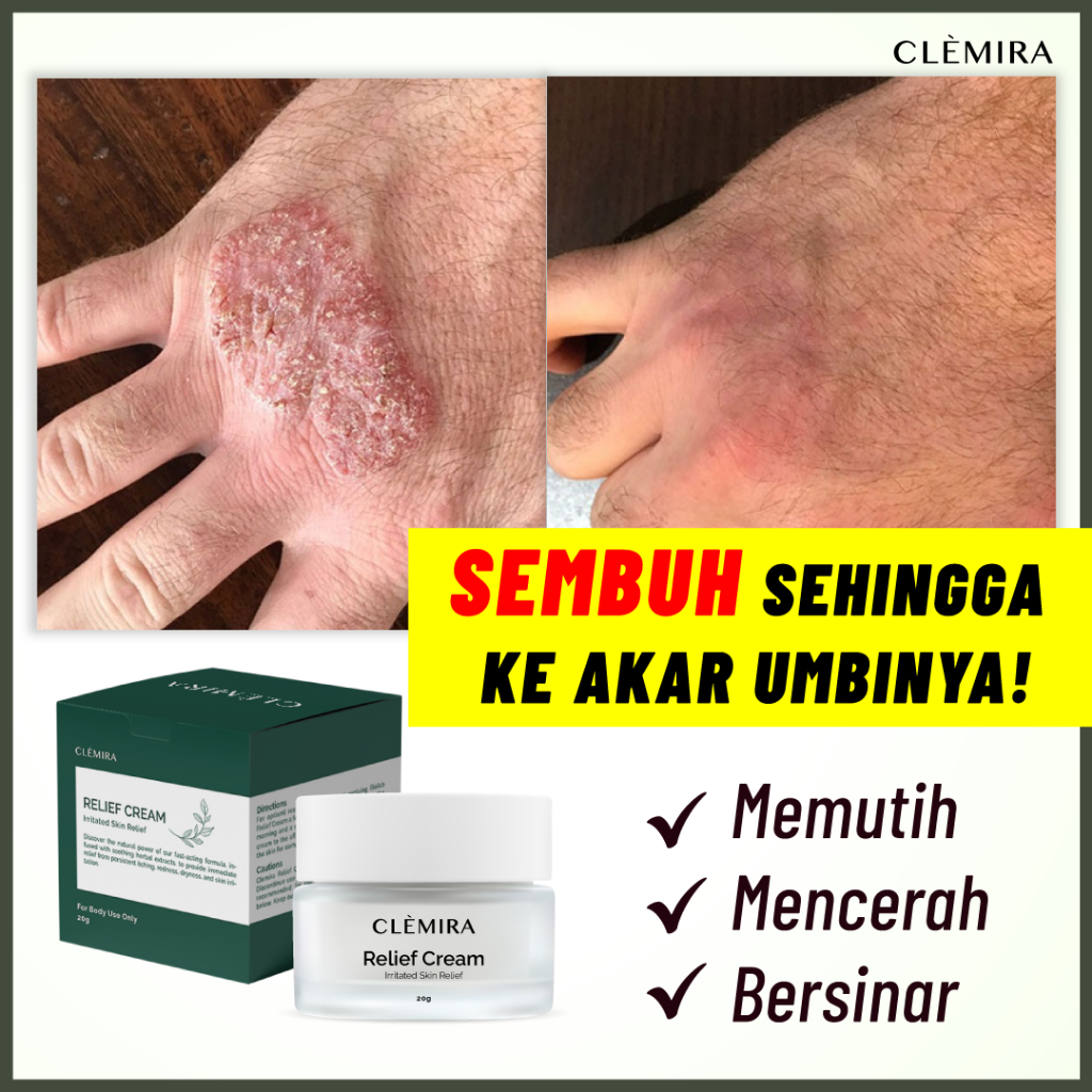 Clemira Relief Cream Ubat Gatal Kulit Ubat Panau Ubat Kurap Ubat Gatal ...