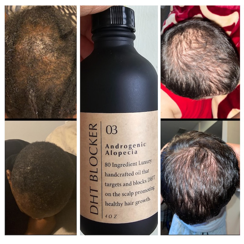 80 Ingredient DHT Blocker Maximum Strength Potent Ayurvedic Non Greasy ...