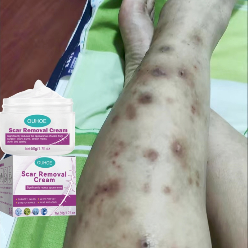 Krim hilangkan parut hitam Hilangkan parut kaki Hilangkan parut luka ...