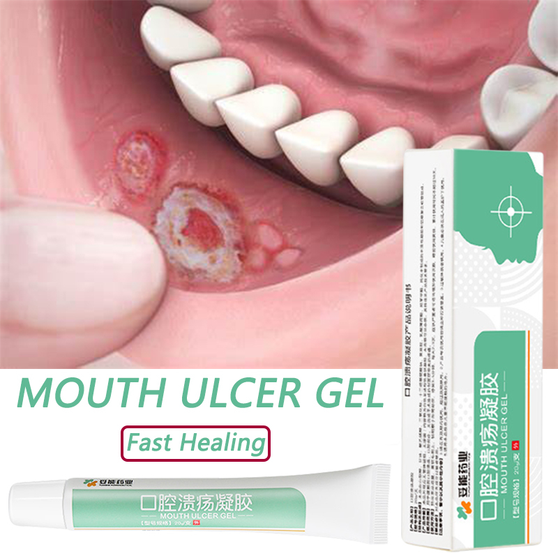 ubat ulser mulut - ulcer gel - oral ulcer gel 20g 口腔溃疡凝胶 rapid recovery ...