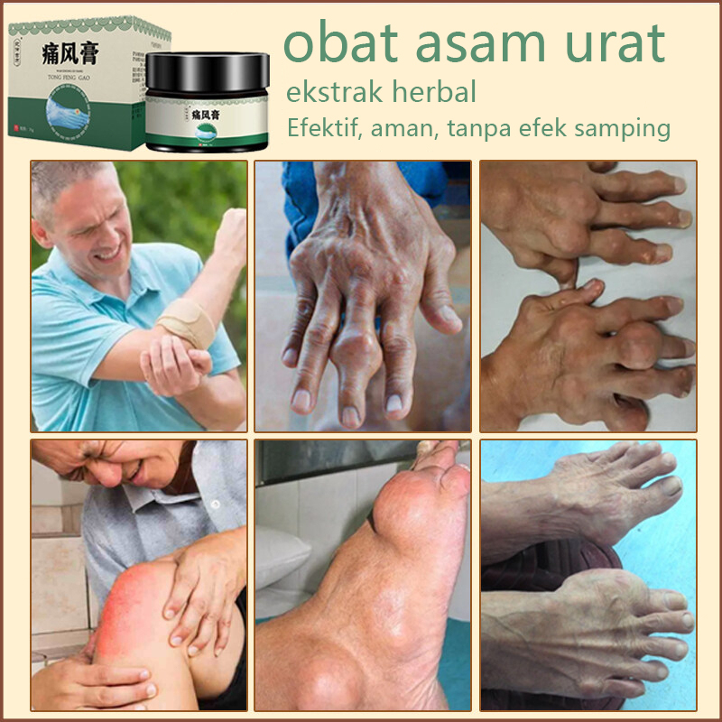 ubat gout - ubat sakit lutut - gout ointment 35g 痛風膏 Natural Chinese ...