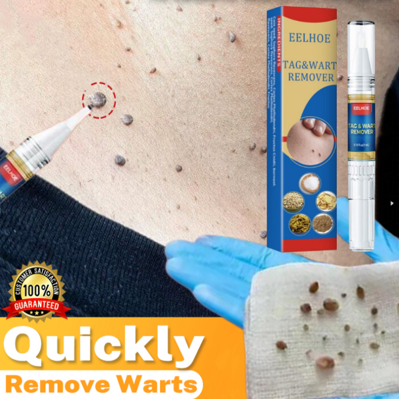 ubat ketuat ubat buang tahi lalat wart remover skin tag remover ubat ...