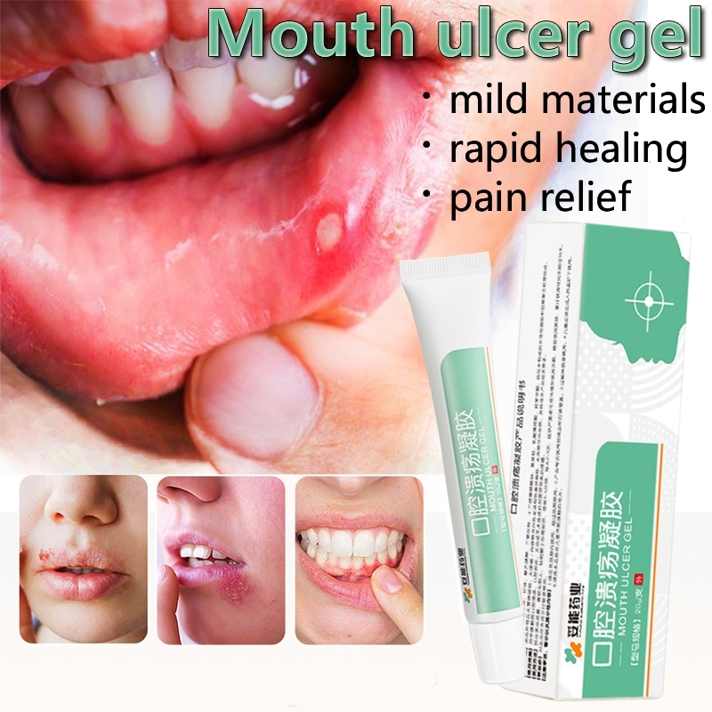Mouth ulcer gel oral ulcer gel 20g canker sore treatment rapid recovery ...