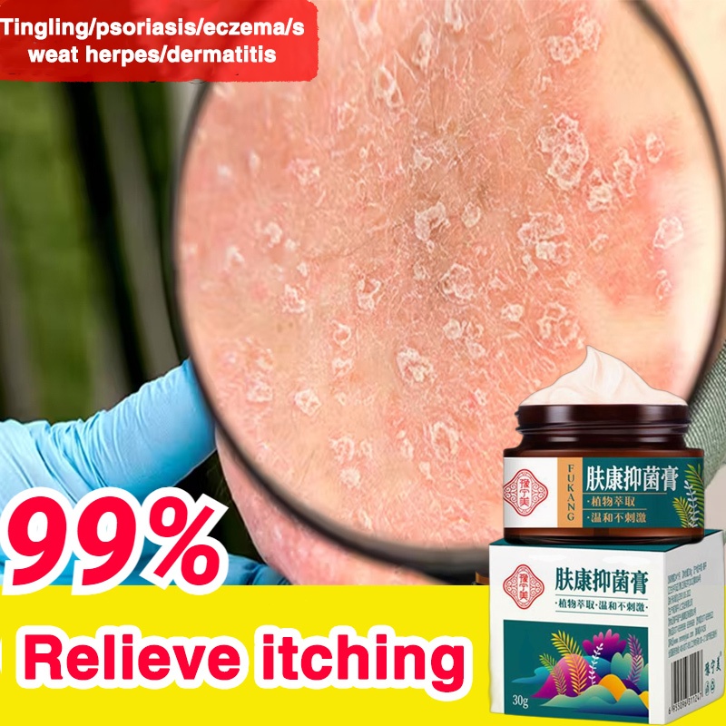 Ubat gatal kulit eczema cream ubat gatal kemaluan 30g scalp psoriasis ...