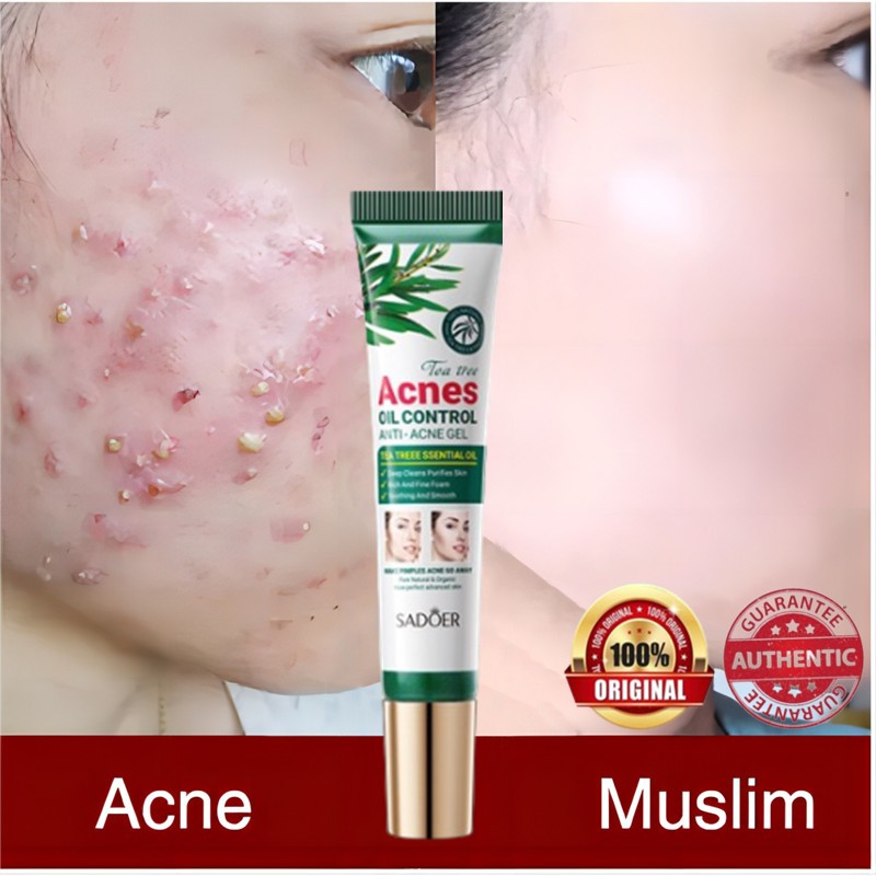 Acne gel Ubat jerawat dan parut Pimple cream Shrinking Pores Acne Cream ...