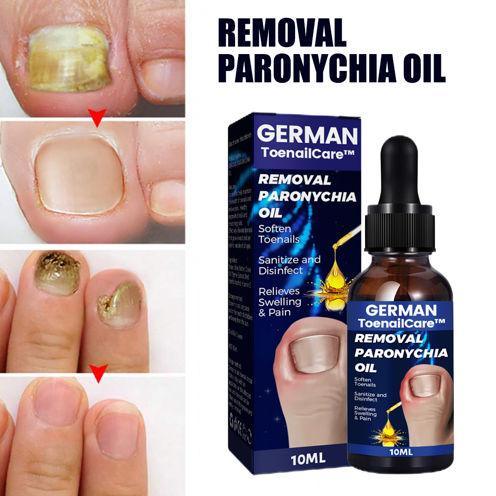 Anti Paronychia Relief Oil Ingrown Toenail Removal Paronychia ...