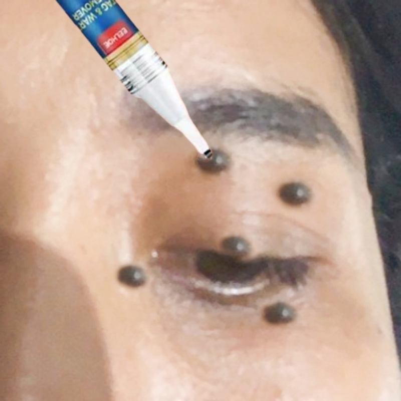 Tahi lalat remover Ubat ketuat Buang tahi lalat dan kutil Skin tag ...