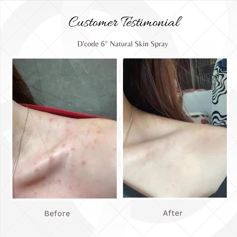 dcode 6 natural skin spray skin disease patients eczema for all kinds ...