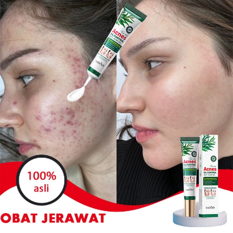 acne gel acne cream acne treatment 20g acne scar treatment Effective ...