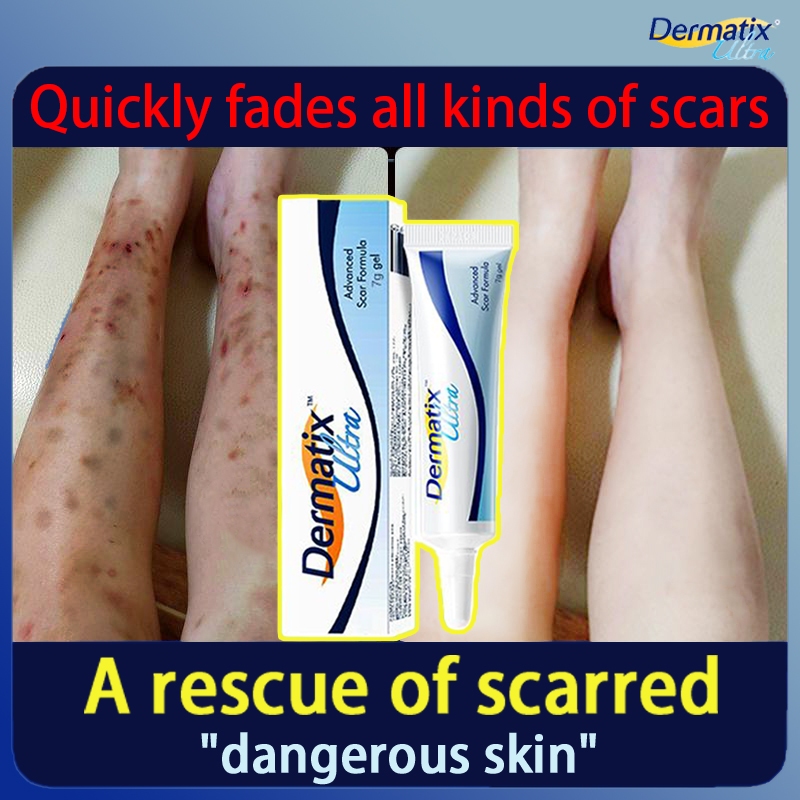 dermatix ultra scar removal cream hilangkan parut jerawat ubat parut ...