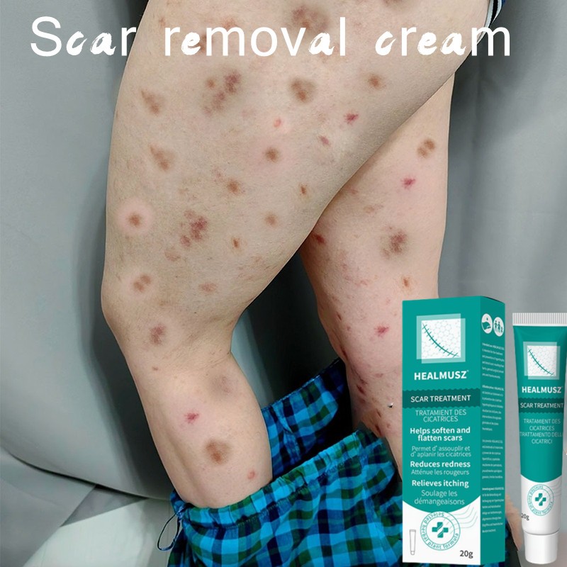 Scar removal cream Krim hilangkan parut hitam Hilangkan parut luka ...