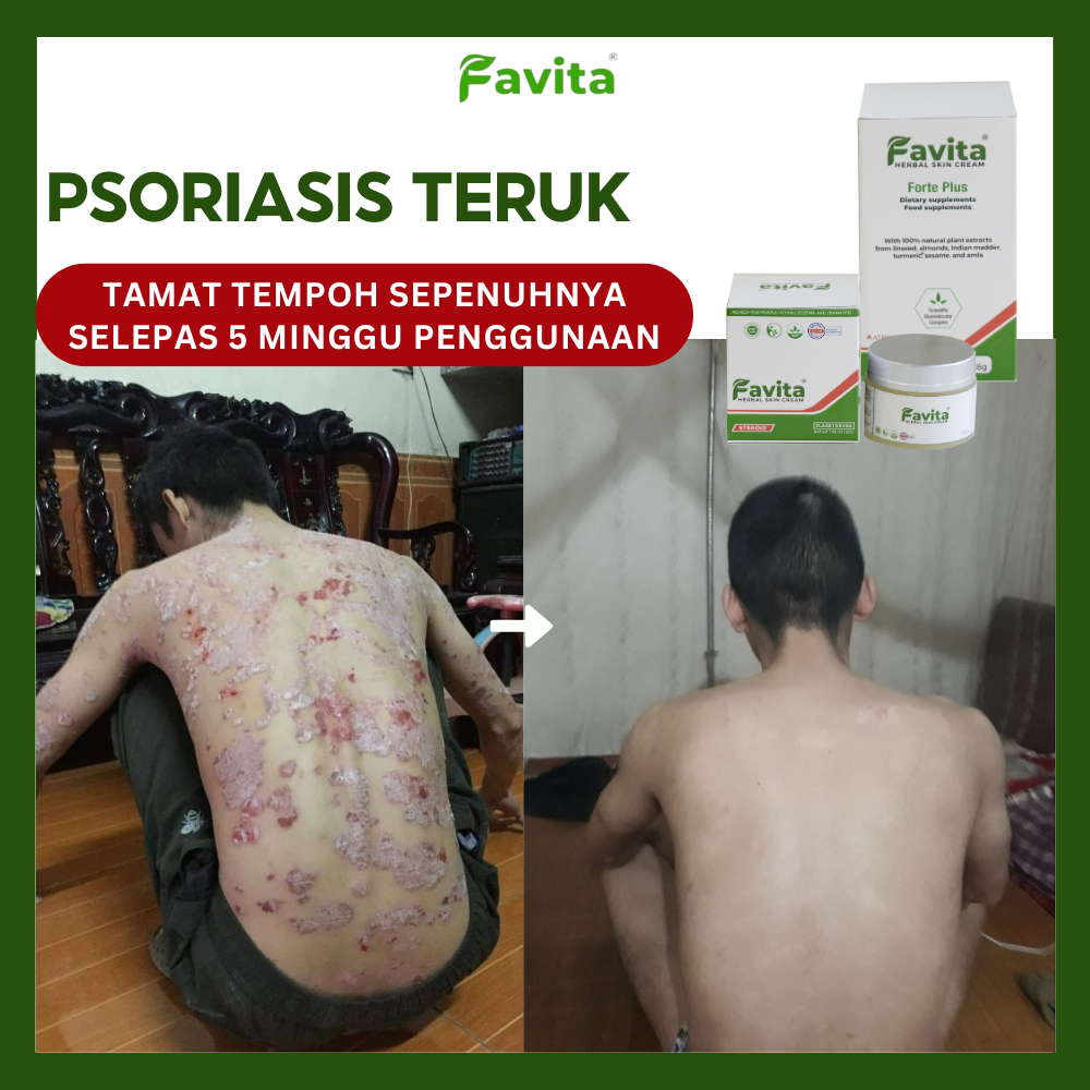 Krim Anti-gatal Favita, Krim Herba, Krim Ekzema, Krim Psoriasis, Krim ...