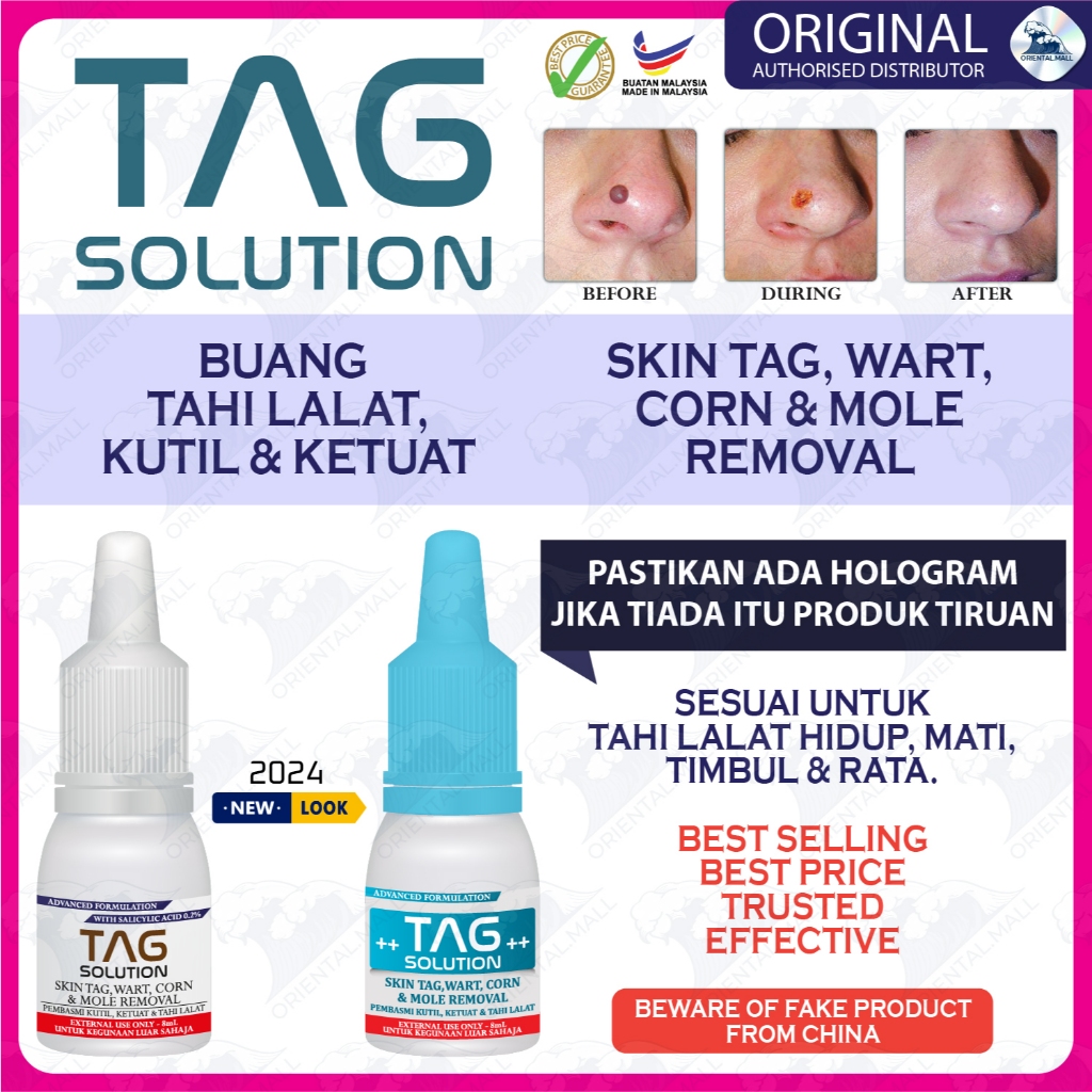 Alat Buang Tahi Lalat, Ketuat, Ketuat Kaki, Kutil 8ml Skin Tag, Mole ...