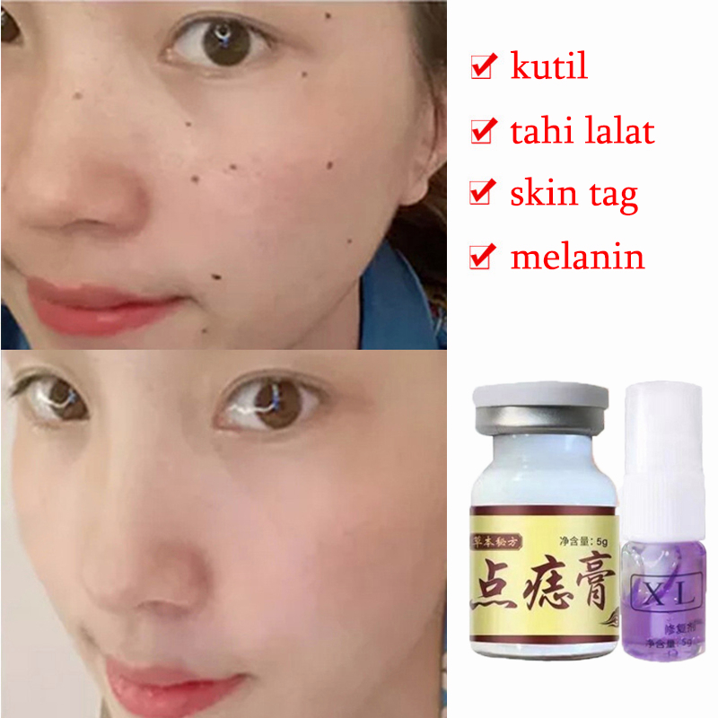ubat kutil mole remover cream skin tag remover biji kolestrol remover ...