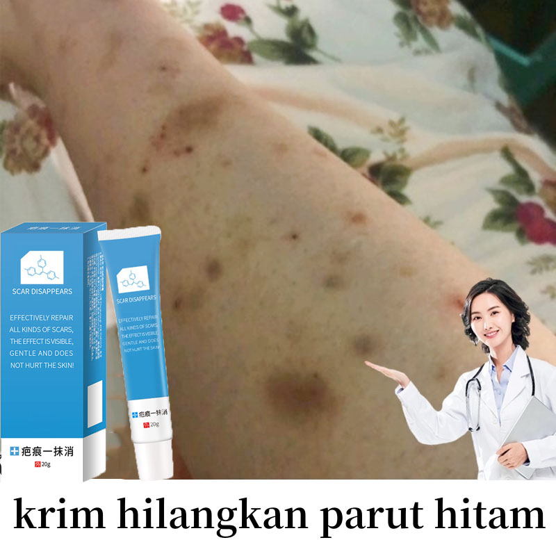 krim hilangkan parut hitam Menghilangkan bekas luka lama Ubat parut ...