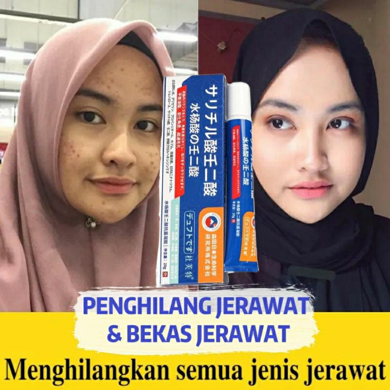 20g JAPAN KRIM SALICYLIC ACID RAWATAN JERAWAT BERJERAWAT & BERMINYAK ...