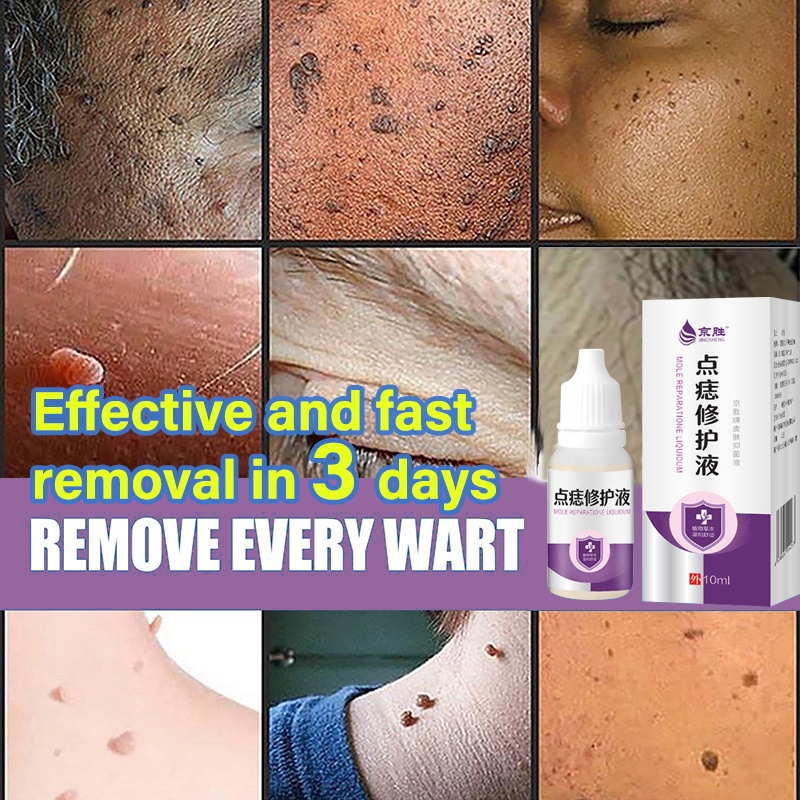 Skin Tags and Warts Removal Mole Removal 10ml mole repair liquid Dilute ...