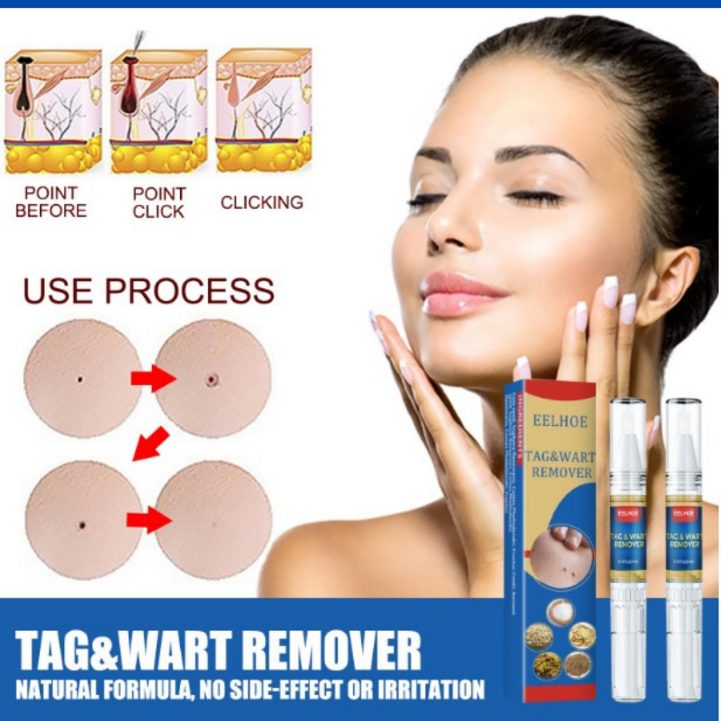 Ubat ketuat Tahi lalat Wart remover Buang tahi lalat dan kutil Biji ...
