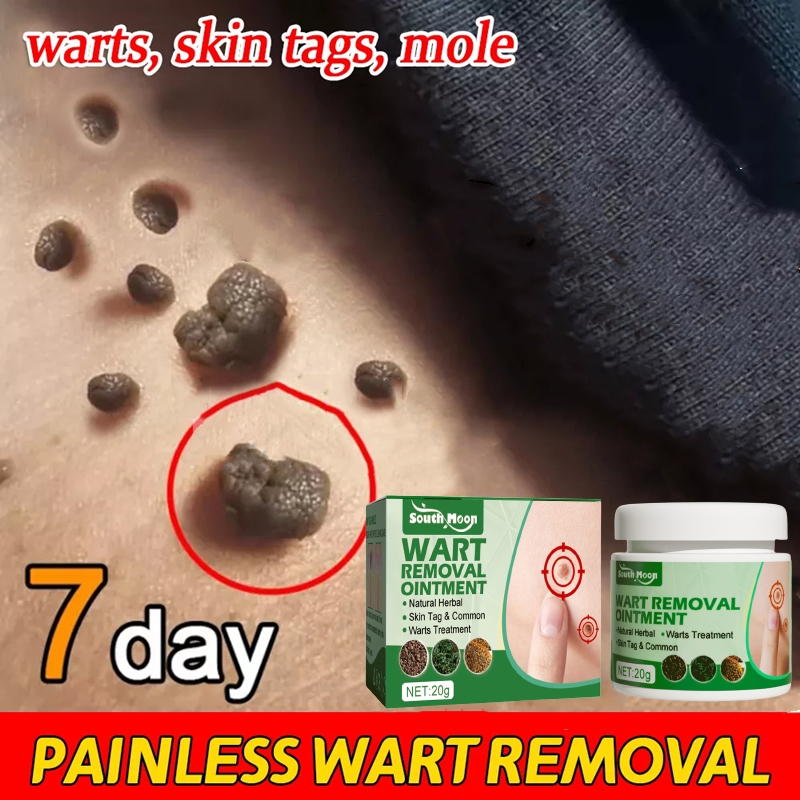 ubat kutil tahi lalat ketuat dan biji kolesterol Wart Removal Cream ...