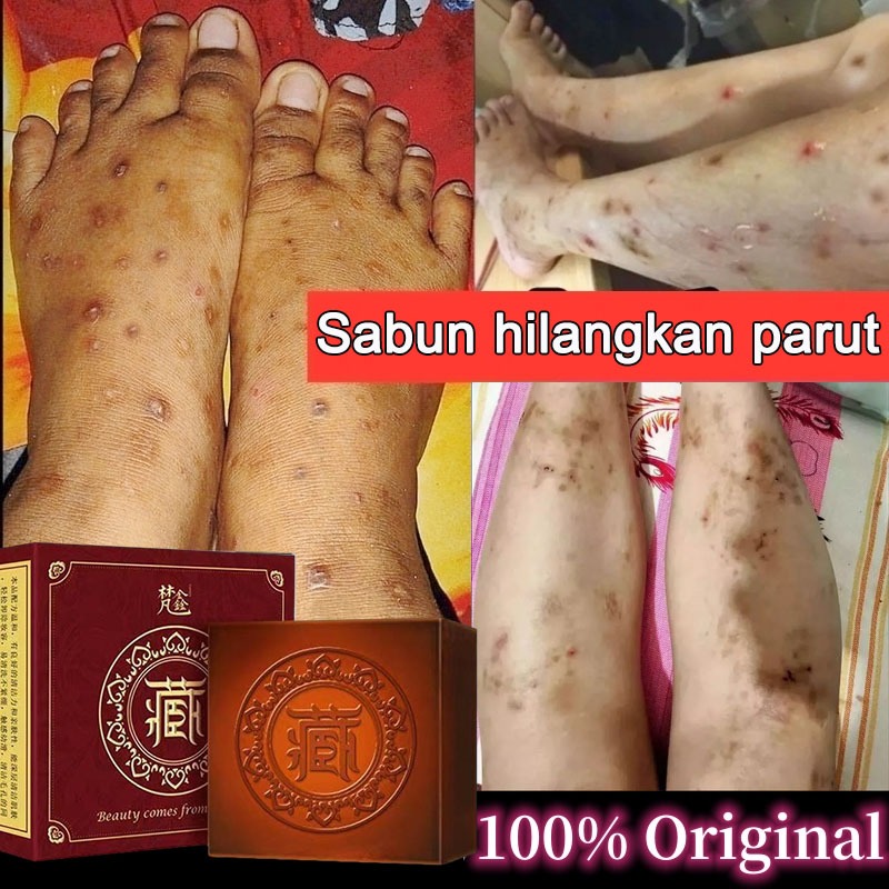 Authentic Tibetan Soap Sabun hilangkan parut kudis Sabun parut kaki ...