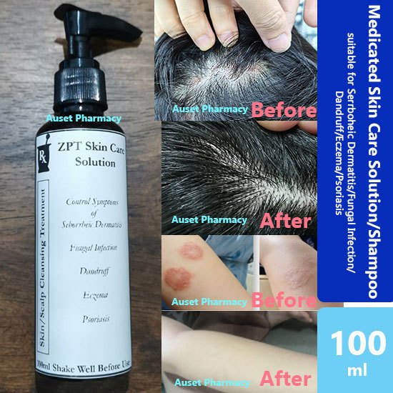 ZPT Skin Care Solution/Shampoo | For Serrboheic Dermatitis/Fungal ...