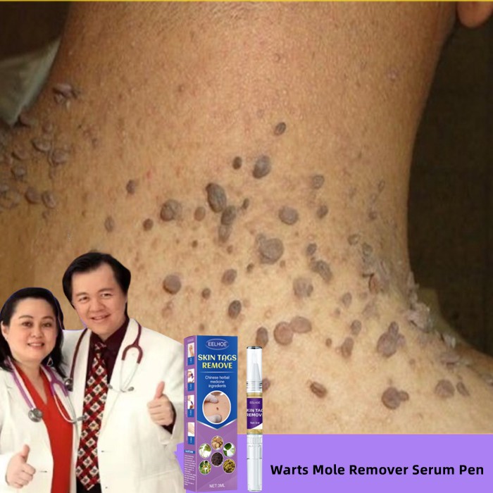 Warts Mole Remover Serum Pen Ubat ketuat Buang tahi lalat dan kutil ...