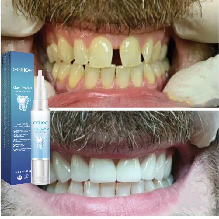 Gum Instant Soothing Gel Receding Gums Therapy Inflammation Treatment ...