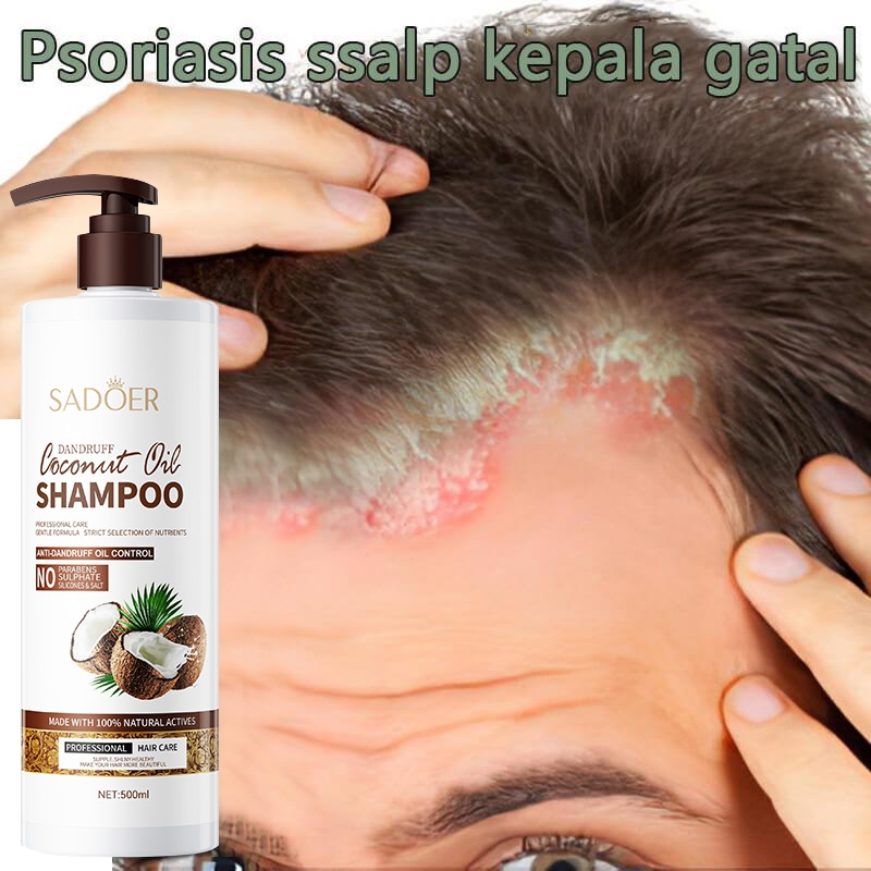 Coconut Shampoo Syampoo kelemumur ubat kepala scalp dandruff kepala psoriasis shampoo itchy ...