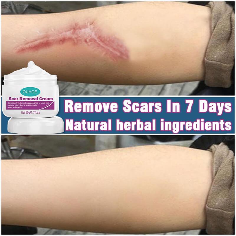 ubat hilangkan parut kudis scar removal cream repair old scars Lighten ...
