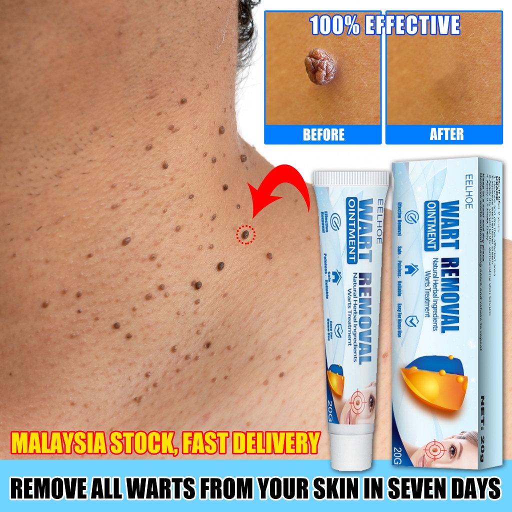 Warts Remover Ointment Ubat Buang Kutil Ketuat Tahi Lalat Biji Kolestrol Warts Skin Tags Remover