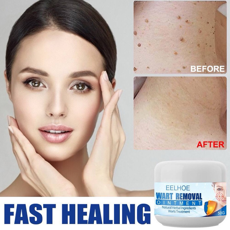 skin tag remover penanggal kutil ketuat tahi lalat bintik hitam biji ...