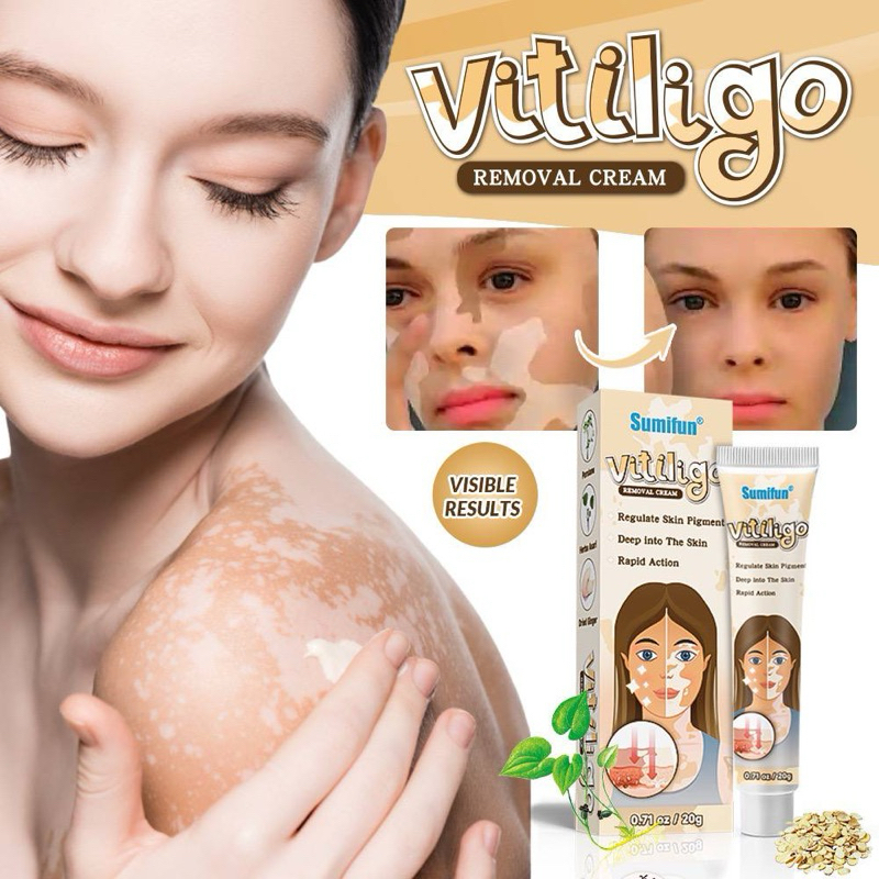 SUMIFUN VITILIGO REMOVAL CREAM krim pembersih vitiligo tompokan kulit ...