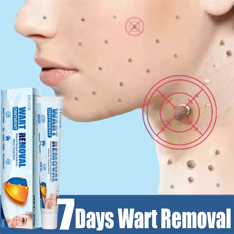 EELHOE Wart Removal Cream 20g Ubat Ketuat Ubat Kutil Mole Remover Cream ...