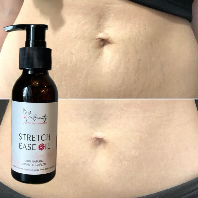 Peggyestore- Premium Stretch Ease Oil Stretch Marks Oil for Pregnancy ...