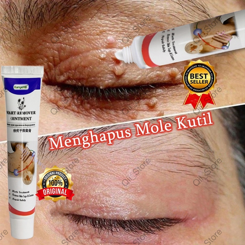 Ubat buang kutil ketuat tahi lalat biji kolestrol Mole Removal Wart ...