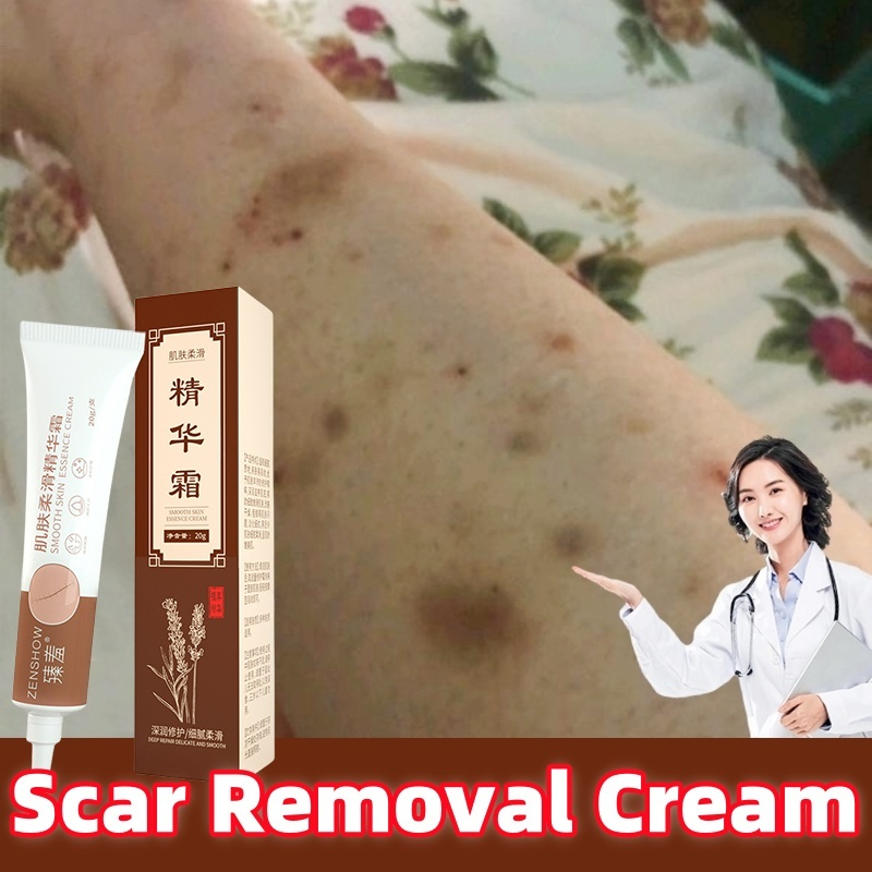 Scar Removal Cream Keloid Scar Remover Krim Parut Kaki Hilangkan Parut ...