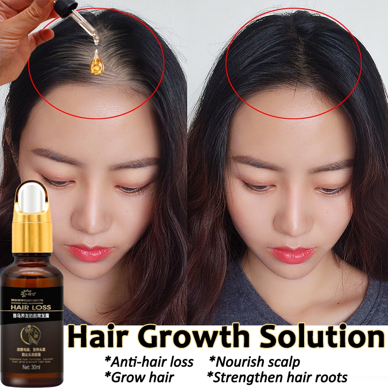 Anti-Hair Loss Solution Hair Grow Serum Root Booster 30ml Anti-dandruff ...