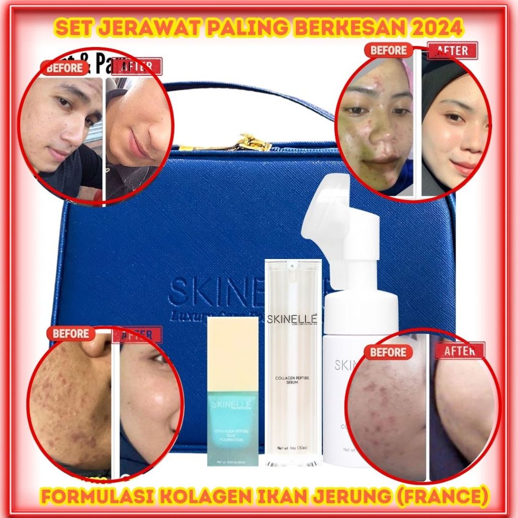 Set Skincare skinelle Jerawat dan Parut Berkesan 2025! | Shopee Malaysia