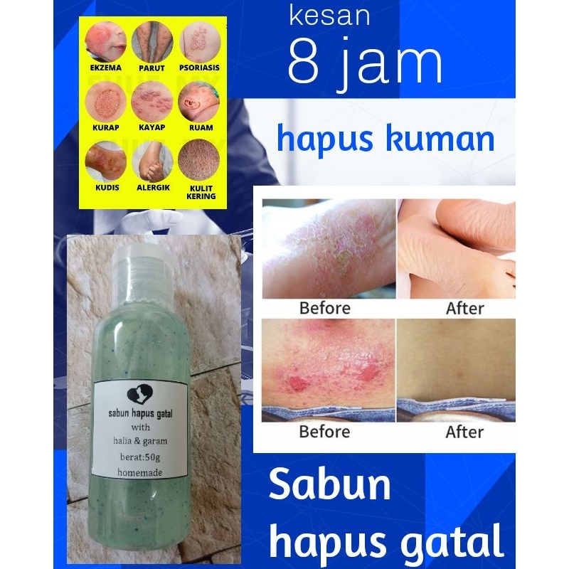 sabun hapus gatal,sabun gatal kurap gigitan serangga,ekzema kudis ...