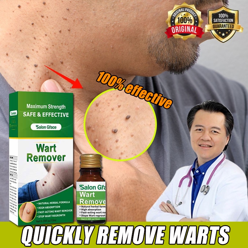 Warts Remover Liquid Skin tag remover Buang tahi lalat dan kutil Buang ...