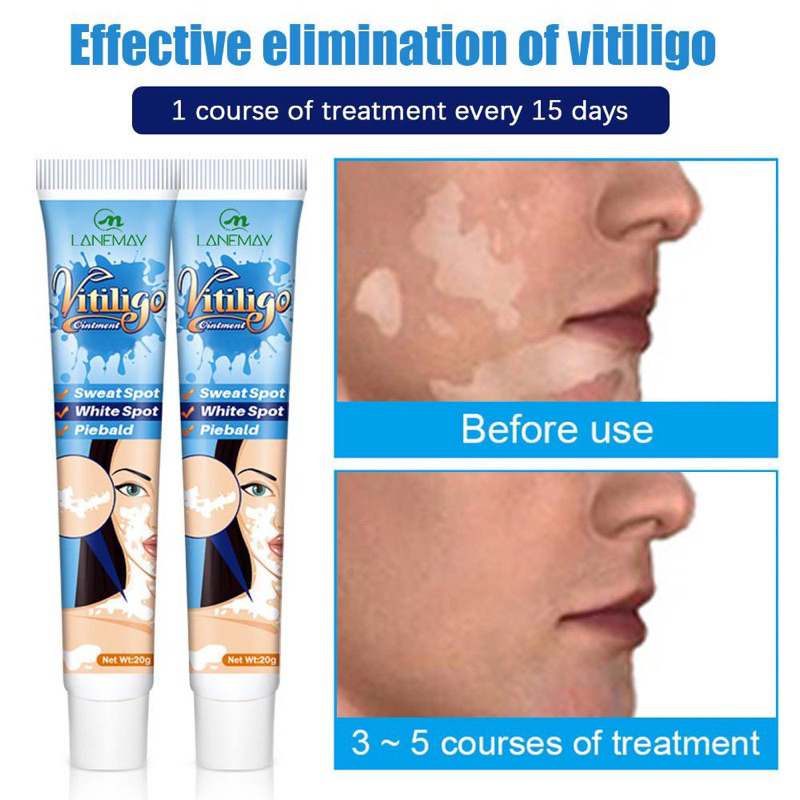 Krim penjagaan kulit menghilangkan vitiligo tompok putih panau kulit ...