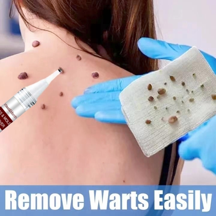 Tahi lalat remover Skin tag remover Buang tahi lalat dan kutil Buang ...