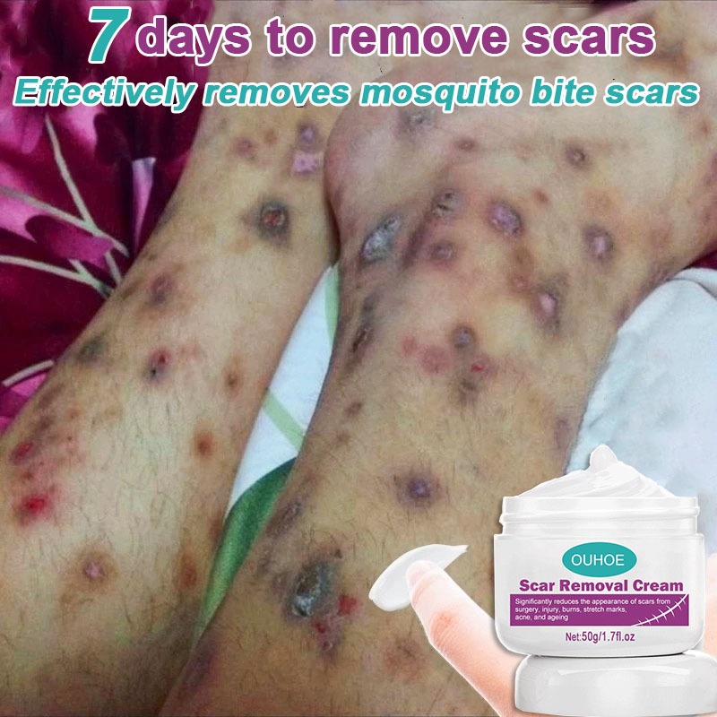 ubat hilangkan parut kudis scar removal cream repair old scars Lighten ...