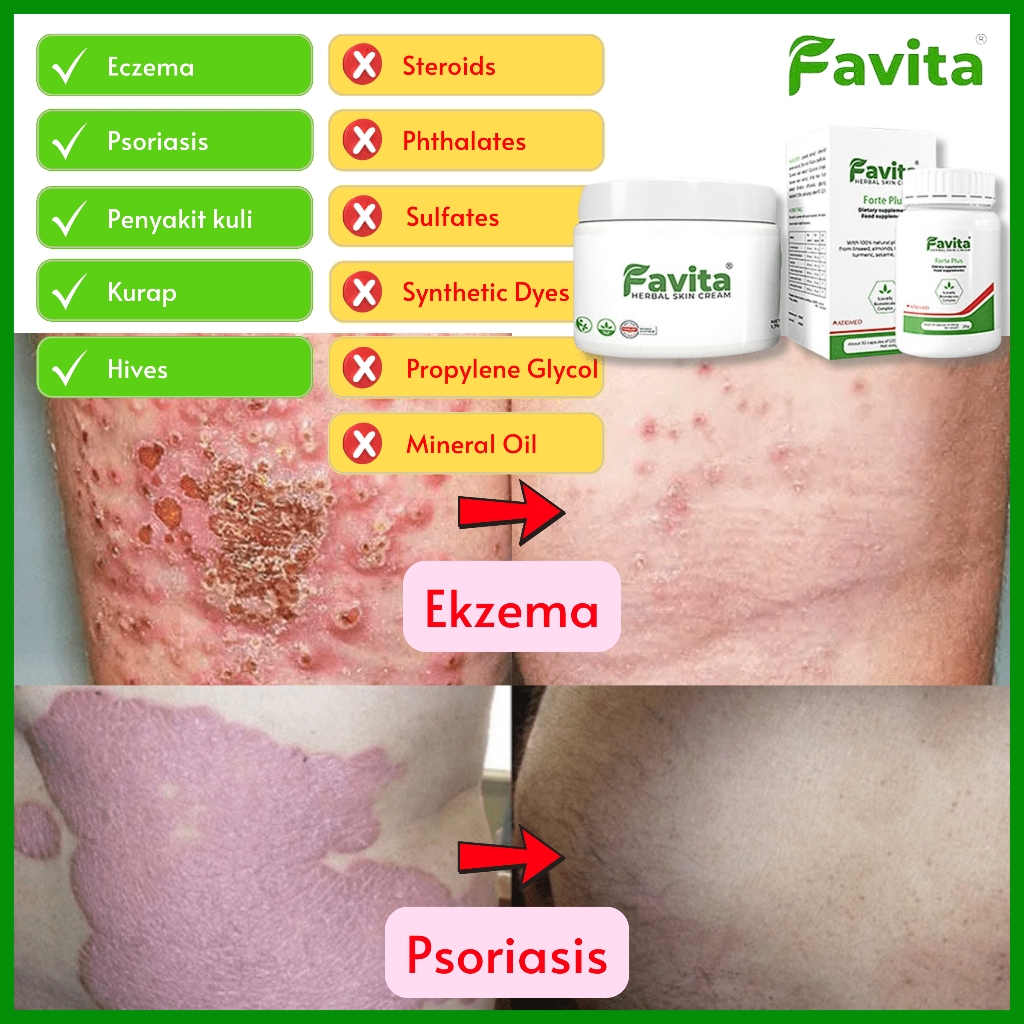Favita Cream dan Pill Penyelesaian Terbaik untuk Kulit Gatal, Eczema ...